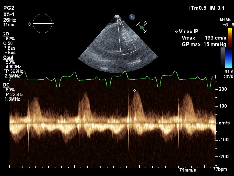 Asystolie ou Adiastolie? – Echocardioblog