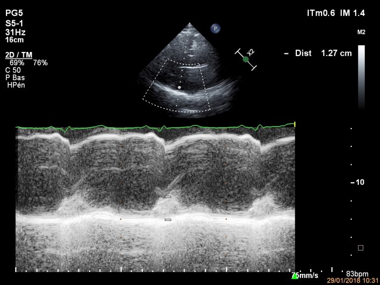 anneau mitral – Echocardioblog